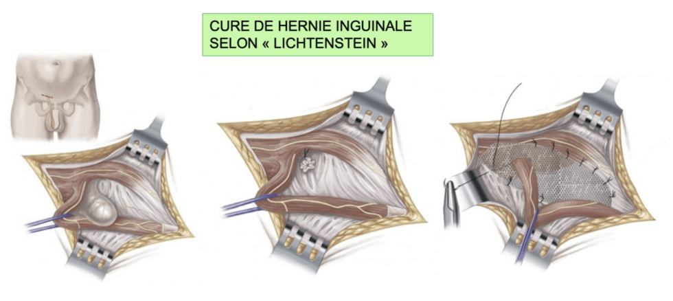 Hernie Ventrale Opération: Chirurgie Laparoscopie Hernie Ventrale – UPFV