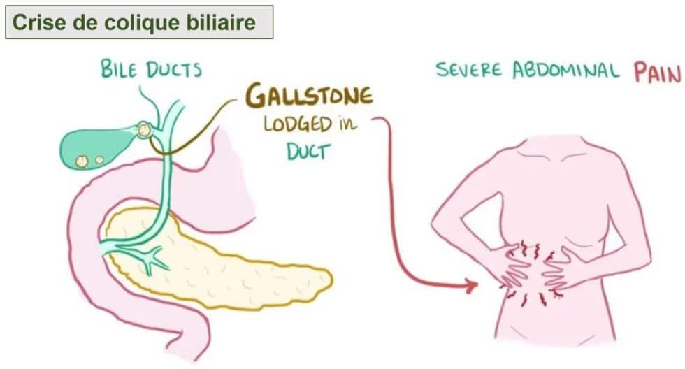 Qu’est-ce que c’est la vésicule biliaire